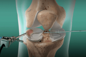 Knee Arthroscopy in Dubai | Arthroscopic Knee Surgery in Dubai