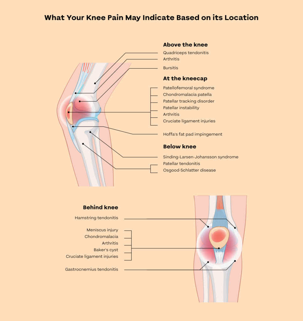 Knee Pain Location Chart Understanding Inner Knee Pain